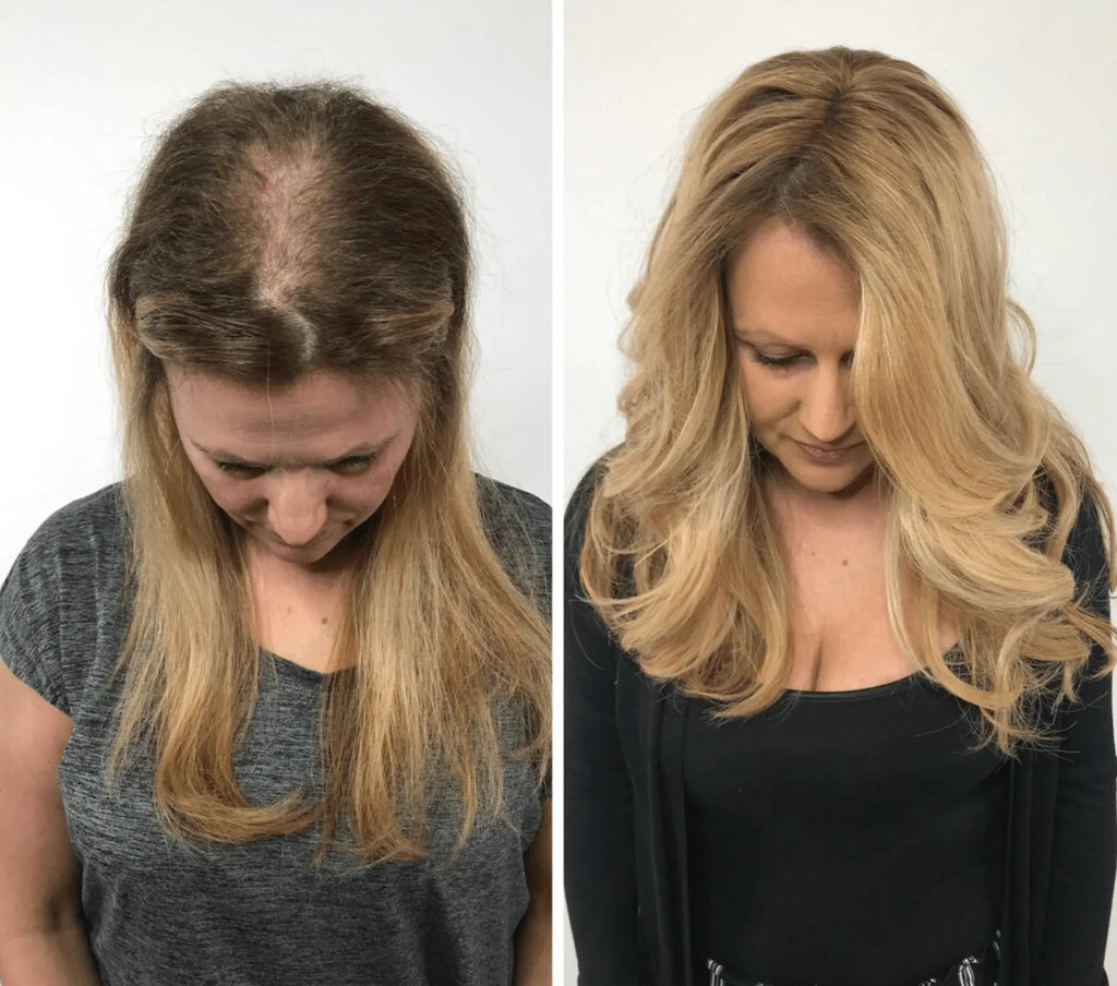 +3 Upgraded Clinical Attachments – VortexHairCare USA